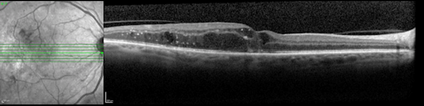 Durability Data in DME | VABYSMO® (faricimab-svoa)