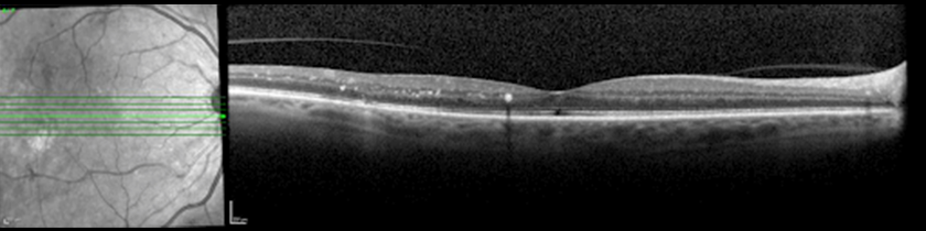 Durability Data in DME | VABYSMO® (faricimab-svoa)