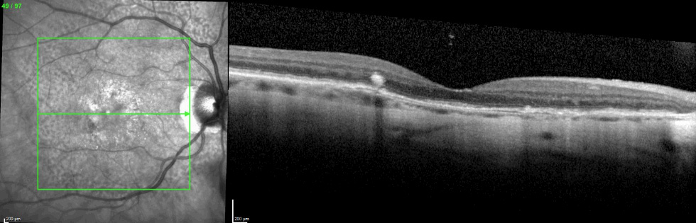 Durability Data in nAMD | VABYSMO® (faricimab-svoa)